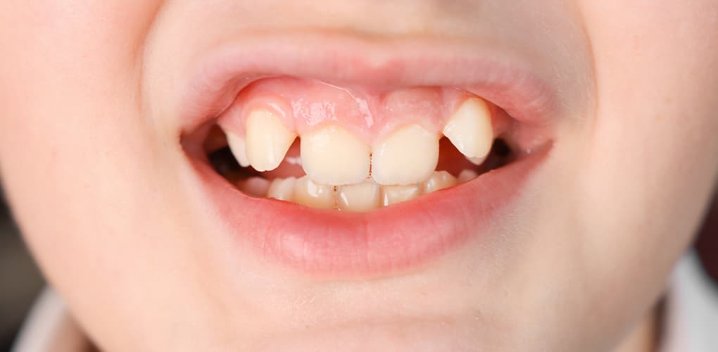 Crowded or Crooked Teeth: Causes, Symptoms, and Treatment Options